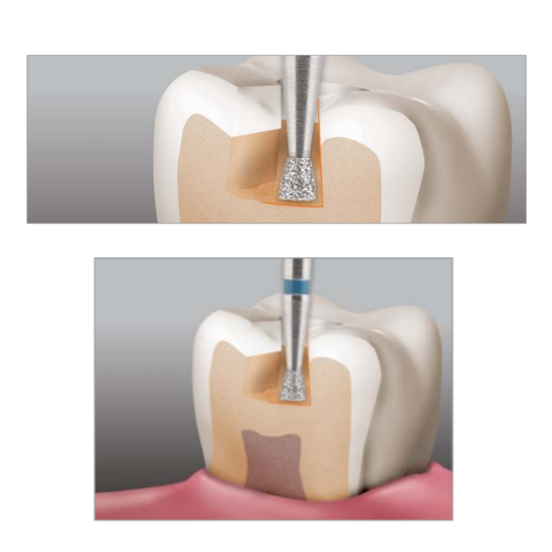Diamond Bur Inverted Cone | J&S Davis